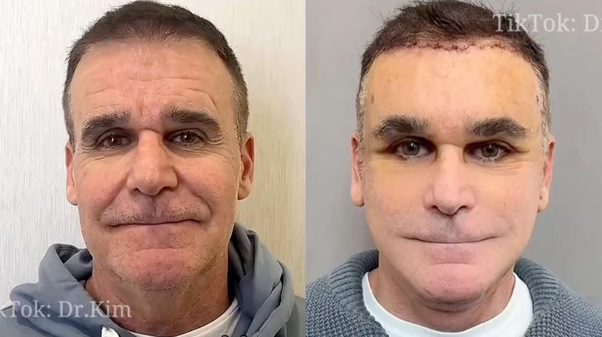 Botched facelift store